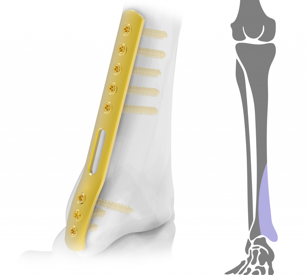 Malleolus 3,5mm - Astrolabe