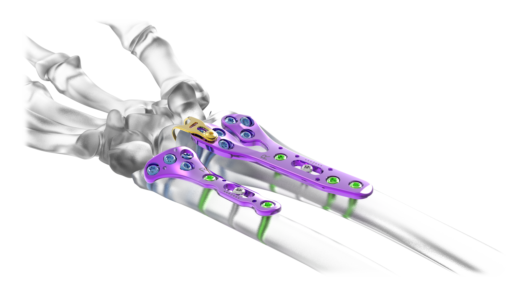 Volar-e system for Radius and Ulna - Astrolabe