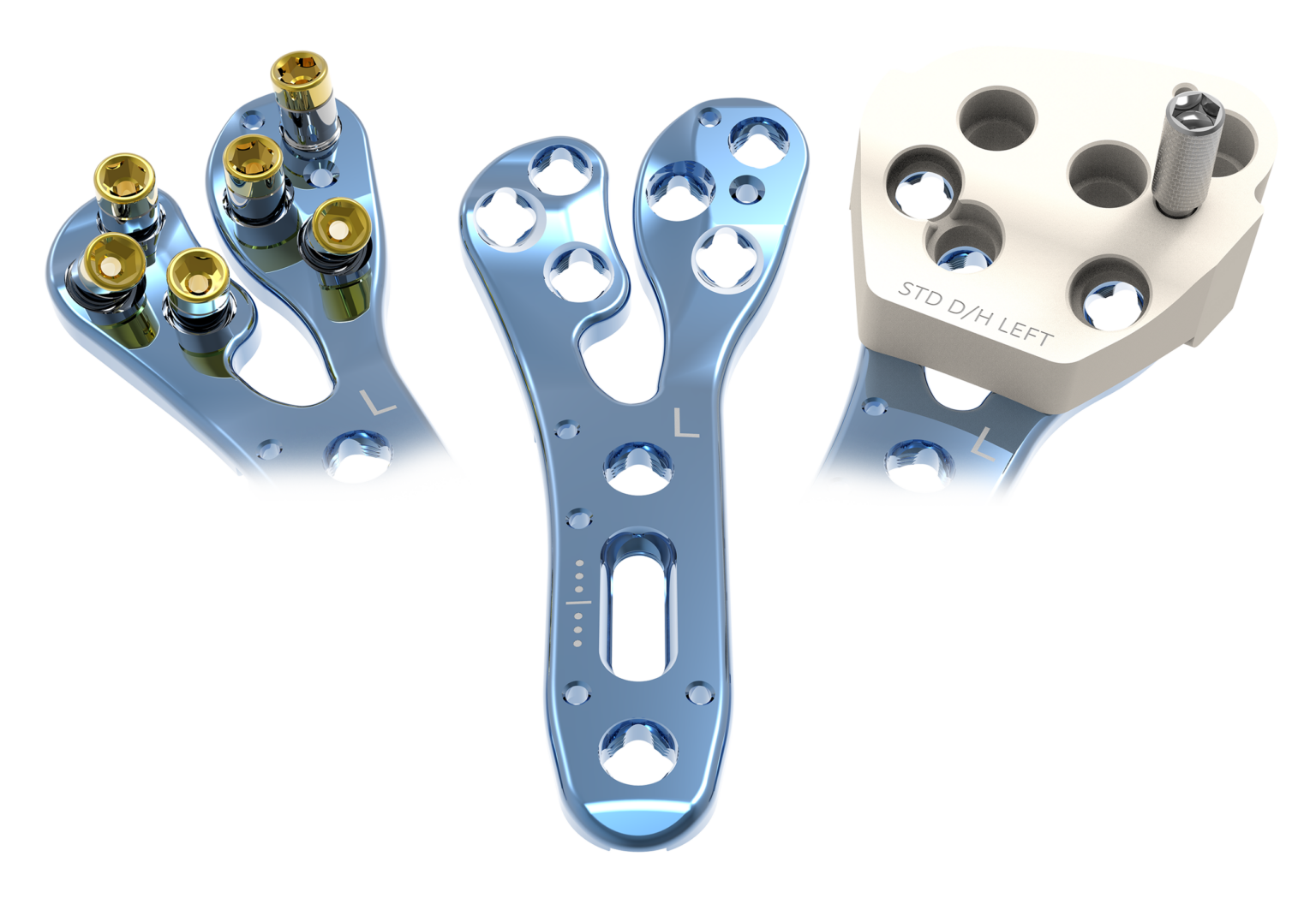 Volar-e system for Radius and Ulna - Astrolabe
